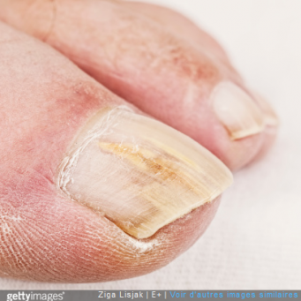 Mycose de l’ongle de l’orteil : pourquoi faut-il la traiter rapidement